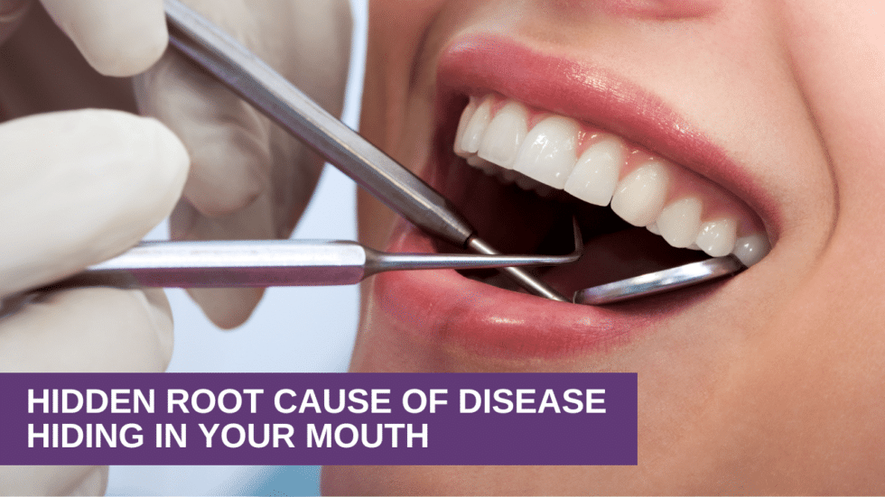 Hidden Root Cause of Disease Hiding In Your Mouth - Genesis Gold